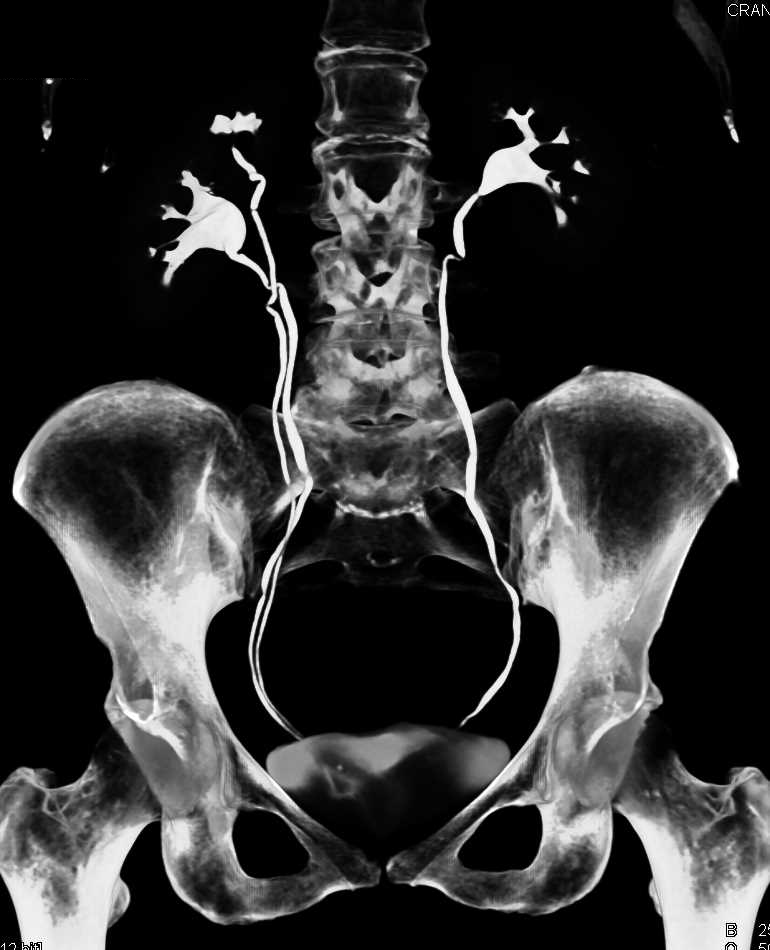 CT Urogram With Duplicated Collecting System Right Kidney Kidney Case