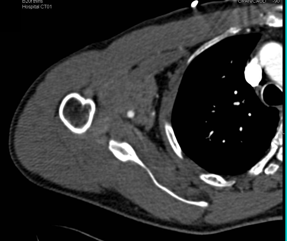 Normal Arterial Anatomy In Upper Extremity Vascular Case Studies Normal Arterial Anatomy In Upper Extremity Vascular Case Studies