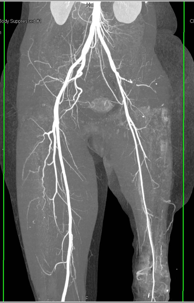 CTA Runoff In Patient With Reimplanted Lower Extremity Vascular Case CTA Runoff In Patient With Reimplanted Lower Extremity Vascular Case