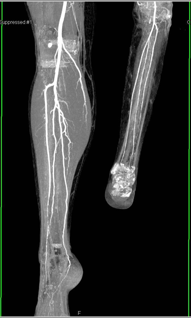 Lower Leg Anatomy Quiz Mri Radiopaedia Hamstring Limb Axial Radiology Lower Leg Anatomy Quiz Mri Radiopaedia Hamstring Limb Axial Radiology