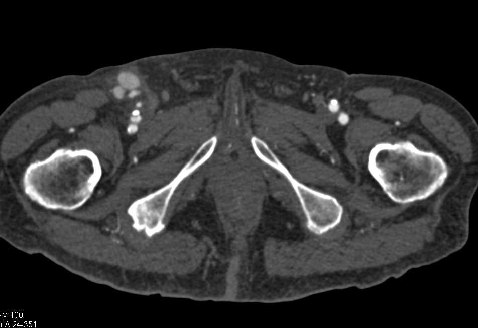 Pseudo Aneurysm Of The Femoral Artery Vascular Case Studies CTisus Pseudo Aneurysm Of The Femoral Artery Vascular Case Studies CTisus