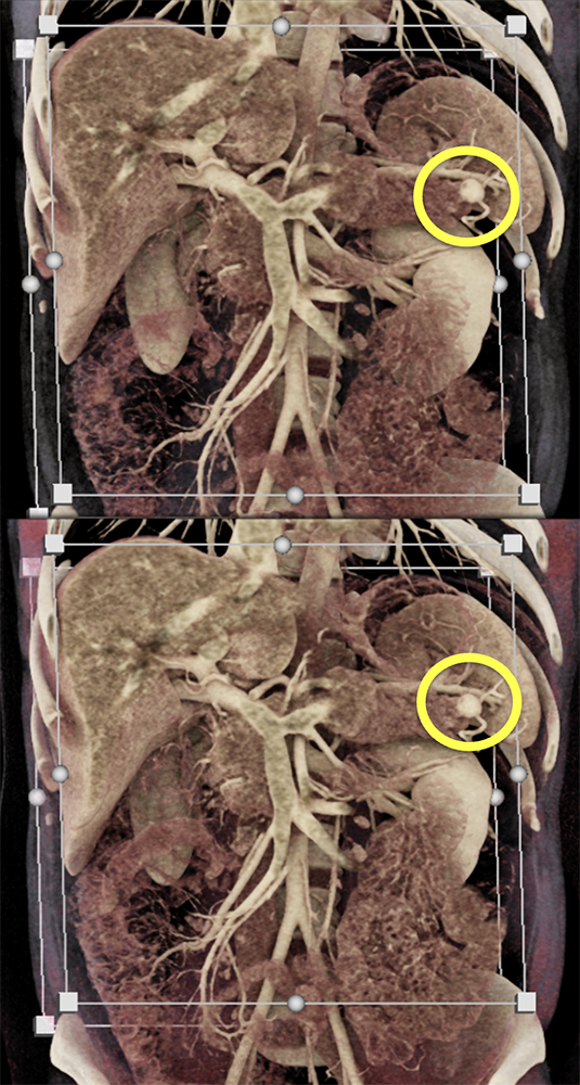 Gastrointestinal - Learning Modules - CTisus.com CT Scanning