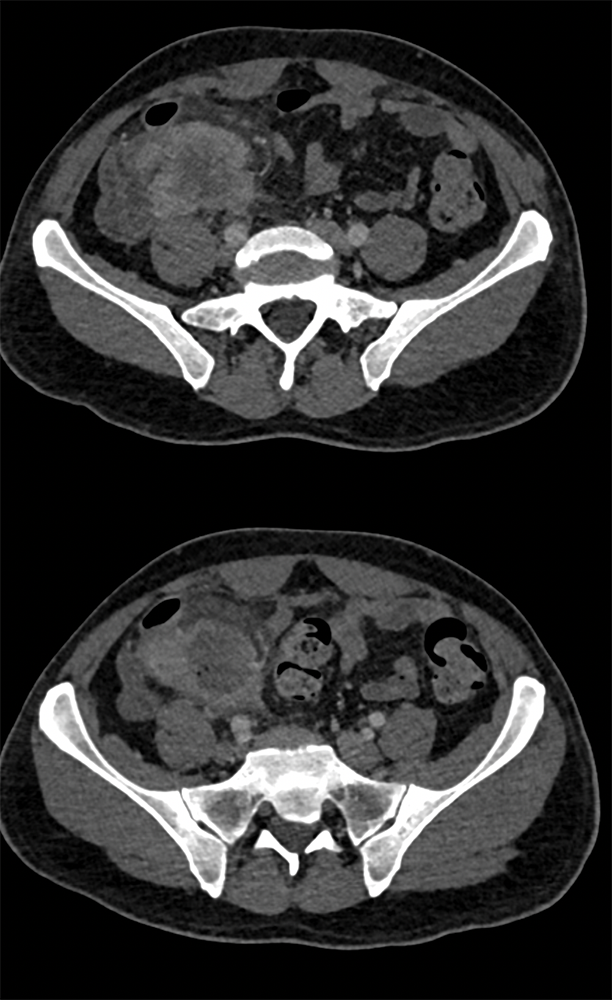 Gastrointestinal - Learning Modules - CTisus.com CT Scanning