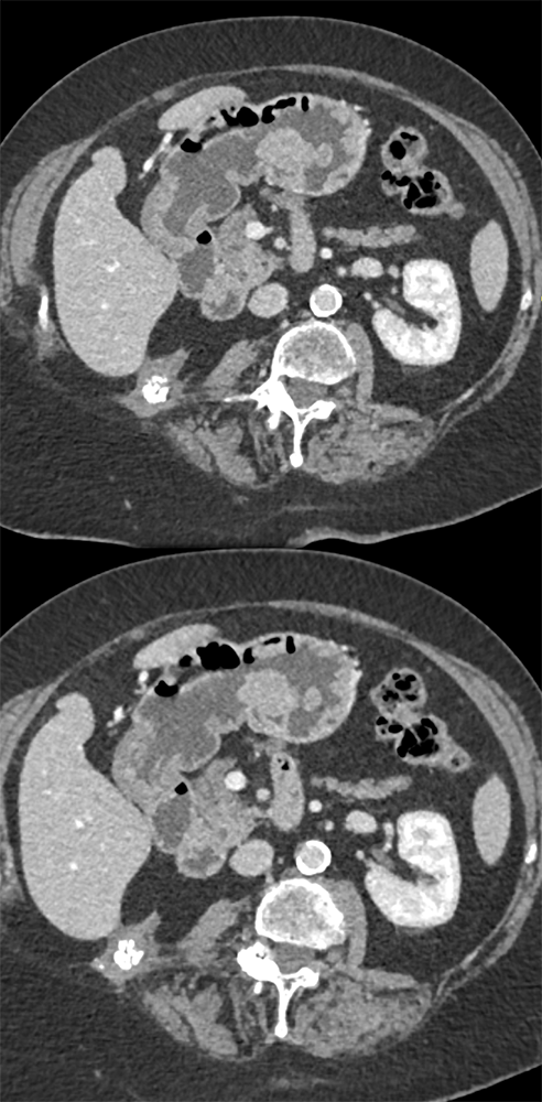 Gastrointestinal - Learning Modules - CTisus.com CT Scanning