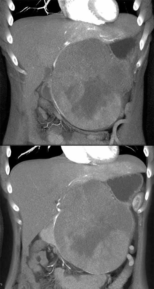 Gastrointestinal - Learning Modules - CTisus.com CT Scanning