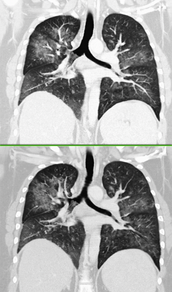 Chest - Learning Modules - CTisus.com CT Scanning