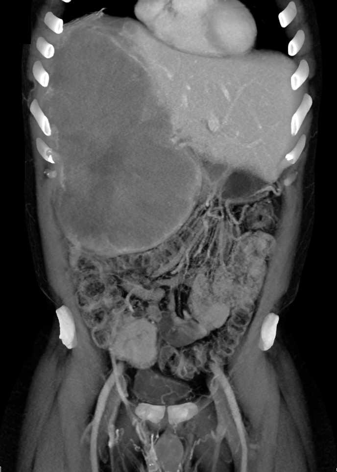 Hepatoma - Liver Radiology Case Studies - CTisus CT Scanning