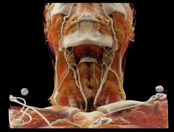CR of the Neck with Vascular Mapping - Neuro Radiology Case Studies ...
