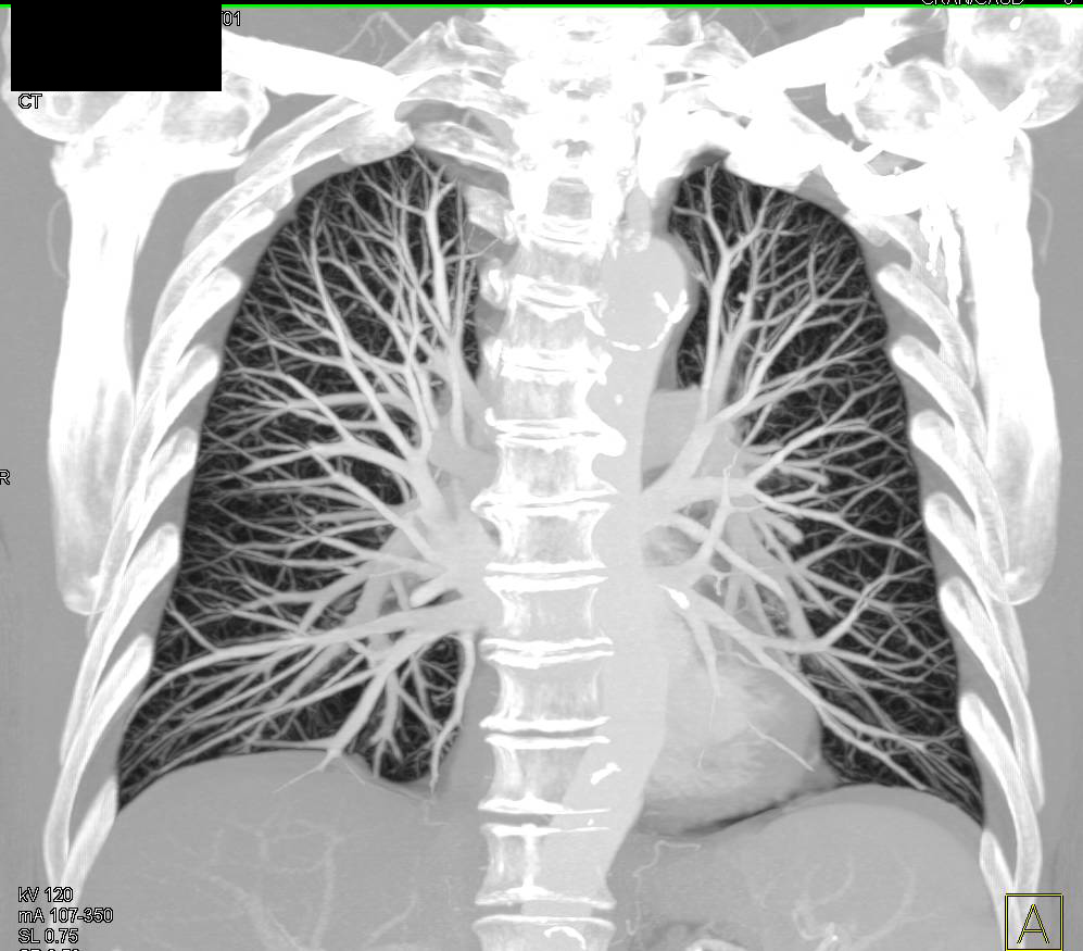 MIP Of Normal Pulmonary Vasculature Chest Case Studies CTisus CT