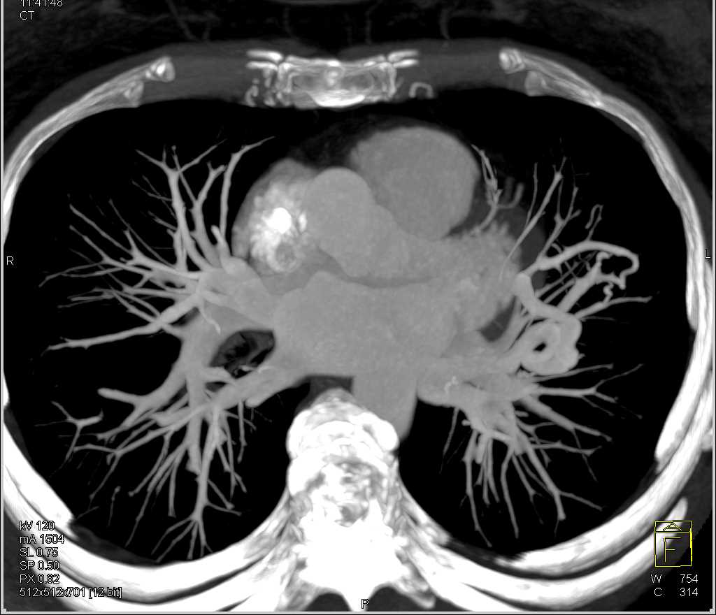 Pulmonary Arteriovenous Malformation AVM Chest Radiology Case Pulmonary Arteriovenous Malformation AVM Chest Radiology Case