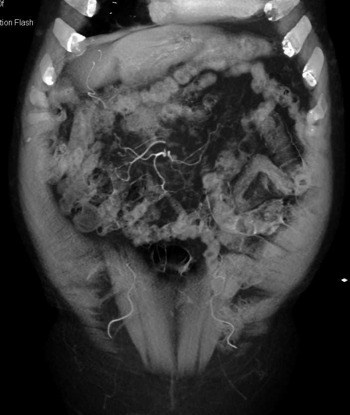 Diverticular Bleed Descending Colon Colon Radiology Case Studies