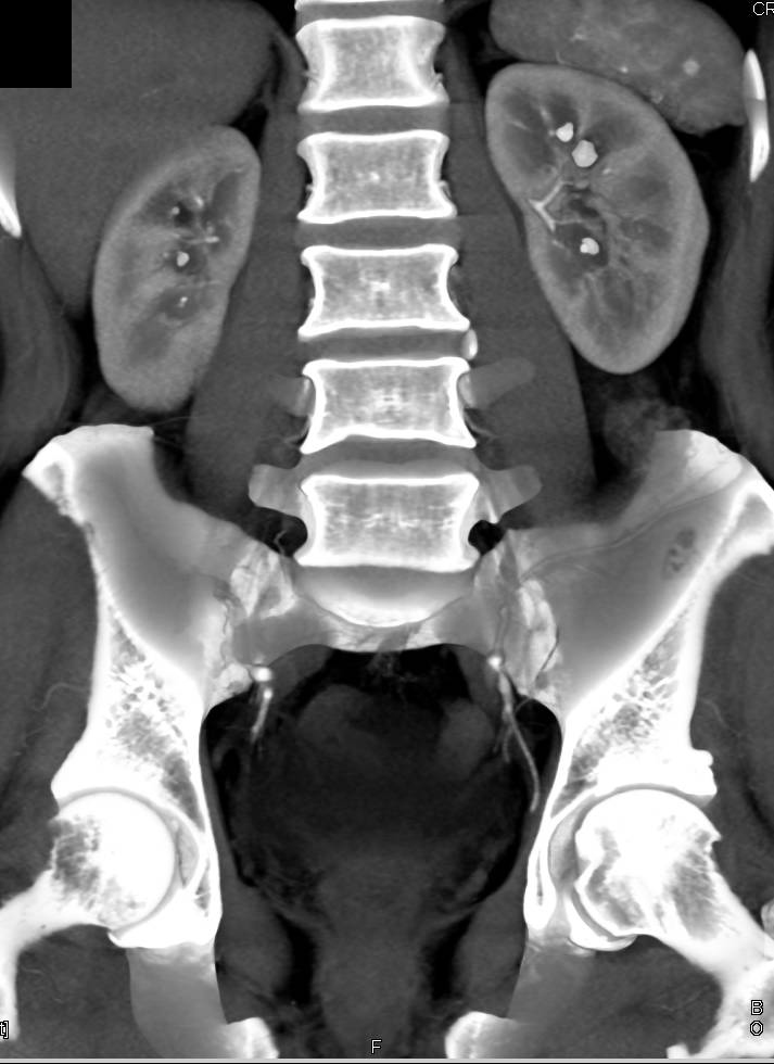 Bilateral Renal Calculi Kidney Case Studies CTisus CT Scanning
