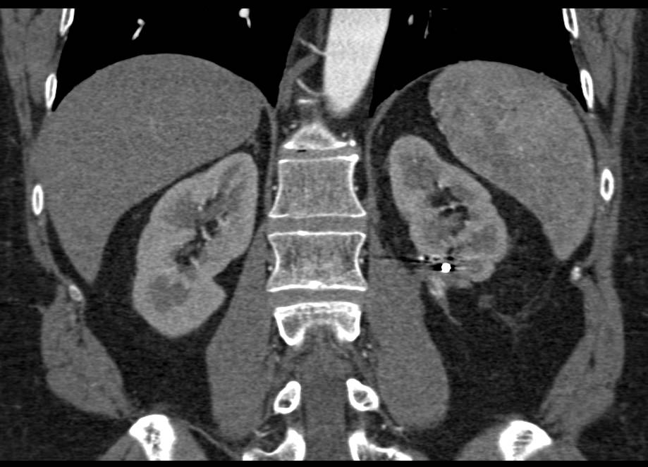 Changes Post Left Partial Nephrectomy Kidney Radiology Case Studies Changes Post Left Partial Nephrectomy Kidney Radiology Case Studies