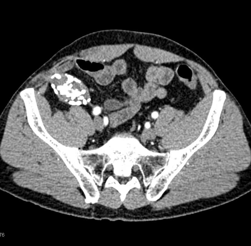 End Stage Renal Disease ESRD With Failed Transplant In The Right