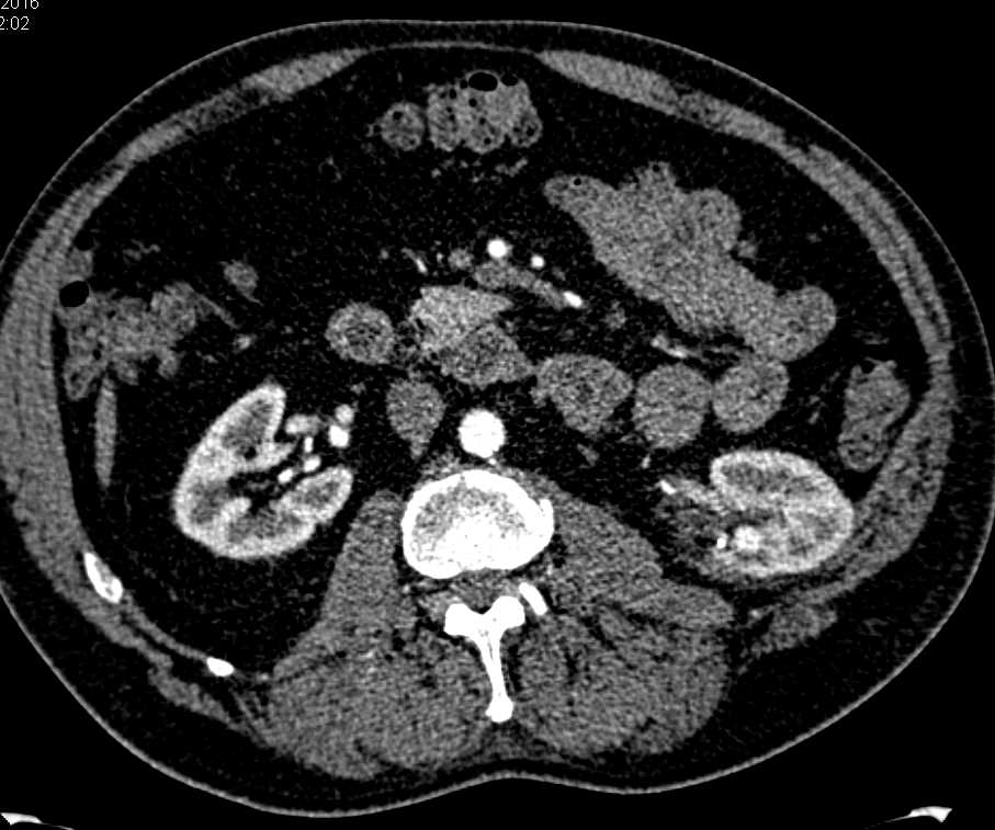 Renal Artery Pseudoaneurysm Near Partial Nephrectomy Site Kidney Renal Artery Pseudoaneurysm Near Partial Nephrectomy Site Kidney