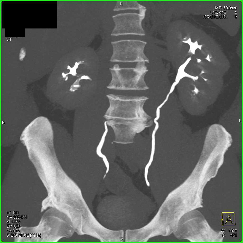 Right Renal Calculus Kidney Case Studies CTisus CT Scanning