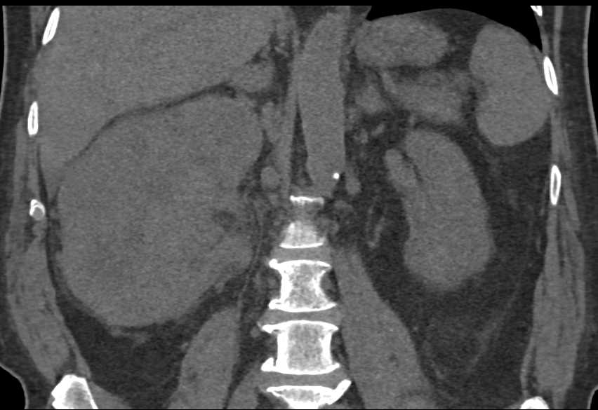 Right Renal Cell Carcinoma Invades The Inferior Vena Cava IVC