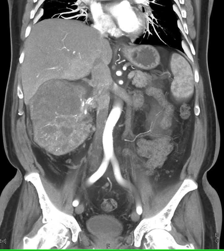 Right Renal Cell Carcinoma Invades The Inferior Vena Cava IVC