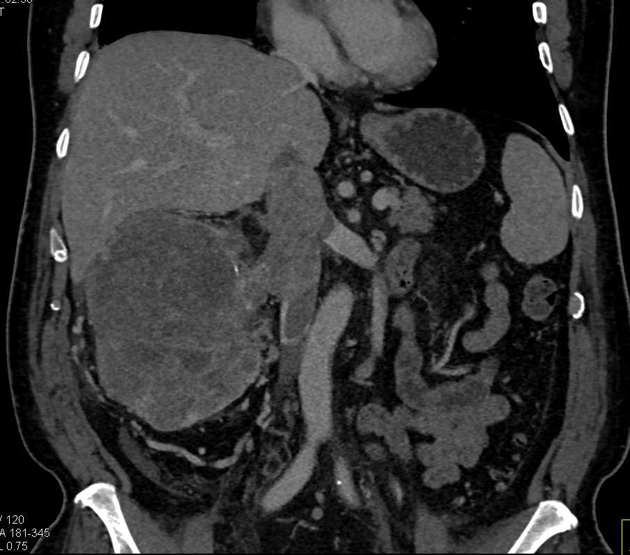 Right Renal Cell Carcinoma Invades The Inferior Vena Cava IVC