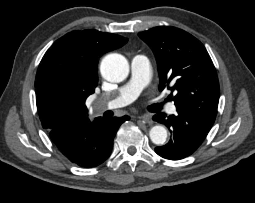 Right Renal Cell Carcinoma Invades The Inferior Vena Cava IVC