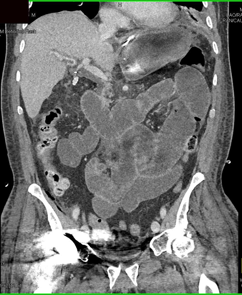 Graft From Iliac Artery To Hepatic Artery Post Liver Transplant Liver Graft From Iliac Artery To Hepatic Artery Post Liver Transplant Liver