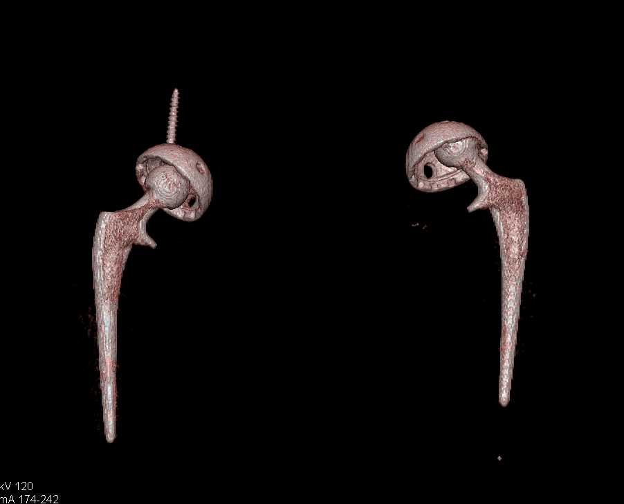 Failed Left Total Hip Replacement Musculoskeletal Radiology Case