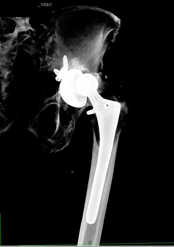 Failed Left Total Hip Replacement Musculoskeletal Radiology Case