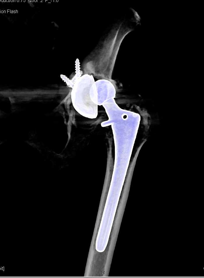 Failed Left Total Hip Replacement Musculoskeletal Radiology Case