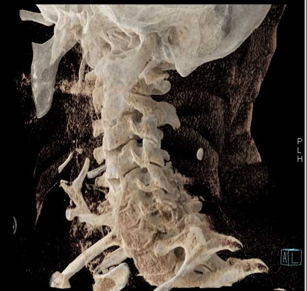 Spinal Repair with Hardware - Musculoskeletal Radiology Case Studies ...