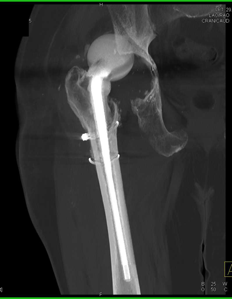Dislocated Right Hip Prosthesis - Musculoskeletal Radiology Case ...