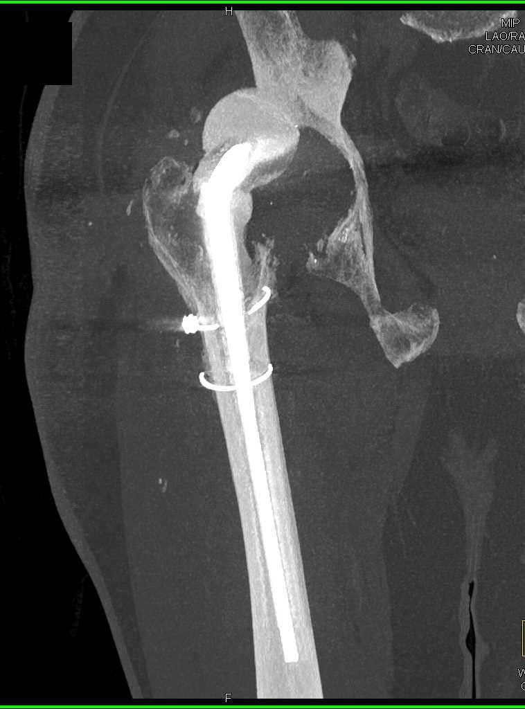Dislocated Right Hip Prosthesis - Musculoskeletal Radiology Case ...