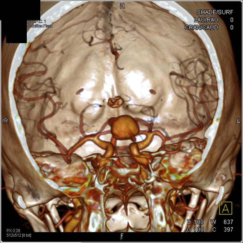 Intracranial Aneurysm In The Circle Of Willis Neuro Case Studies 