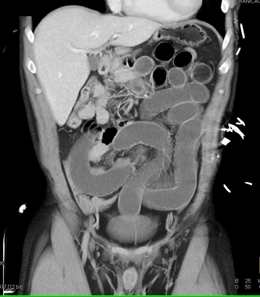 Small Bowel Obstruction Due To Adhesions Small Bowel Case Studies Small Bowel Obstruction Due To Adhesions Small Bowel Case Studies