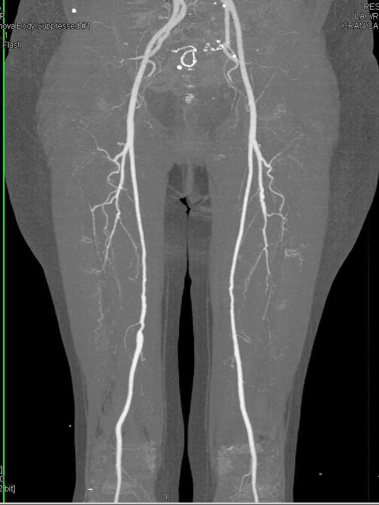 Dual Energy CT Angiogram With Peripheral Vascular Disease In Dual Energy CT Angiogram With Peripheral Vascular Disease In