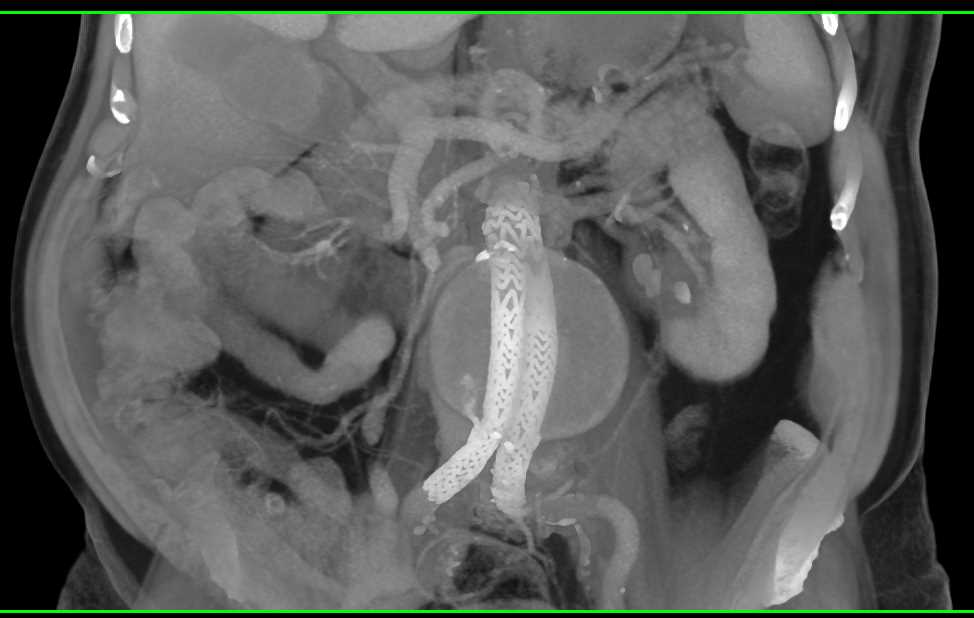 Endovascular Stent Repair Of Abdominal Aortic Aneurysm With Endoleak