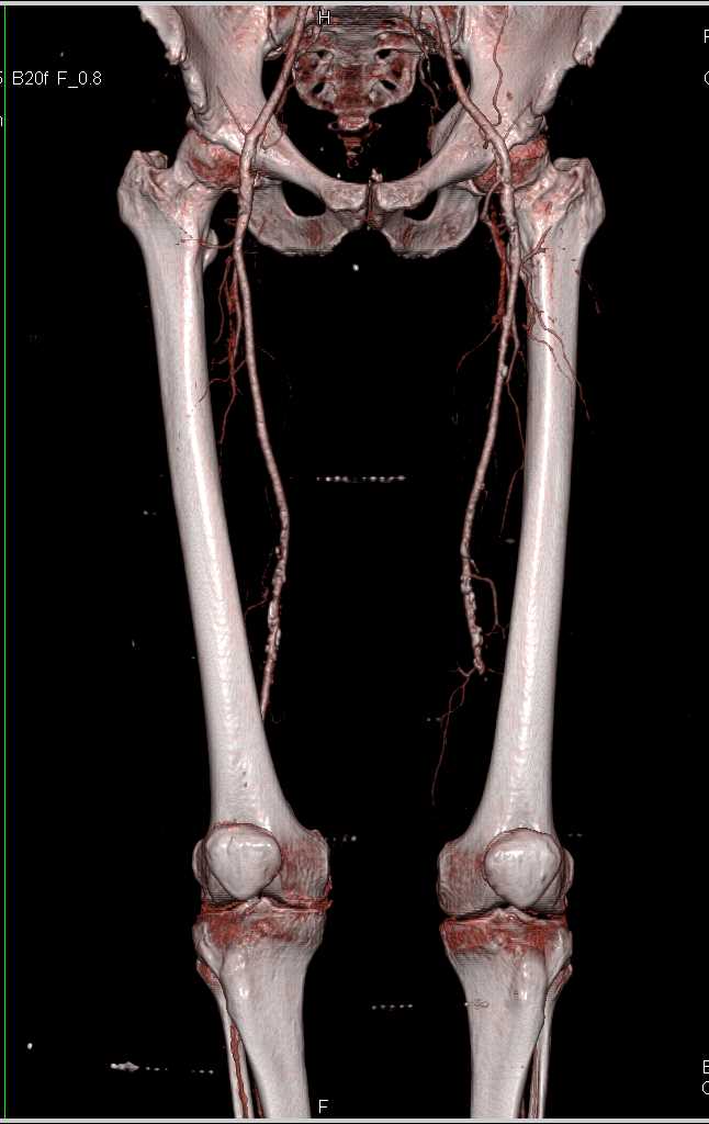 CTA Runoff With Left Superficial Femoral Artery SFA Occlusion 