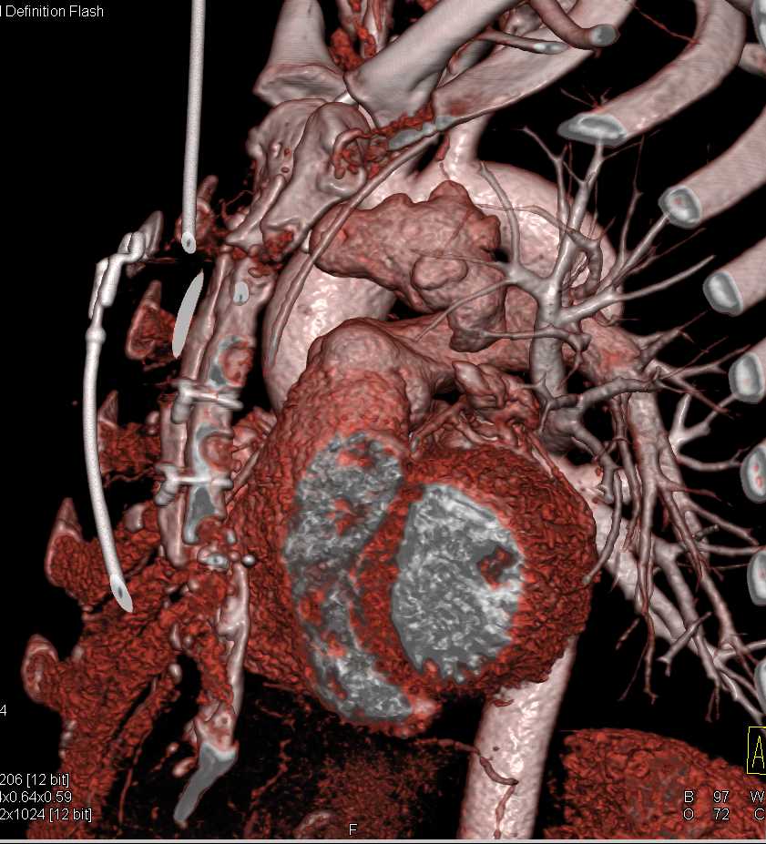 Leaking Aortic Aneurysm Vascular Case Studies CTisus CT Scanning
