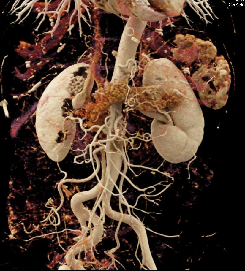 Coiling Of Pelvic Arteriovenous Malformation AVM In Right Pelvic Coiling Of Pelvic Arteriovenous Malformation AVM In Right Pelvic