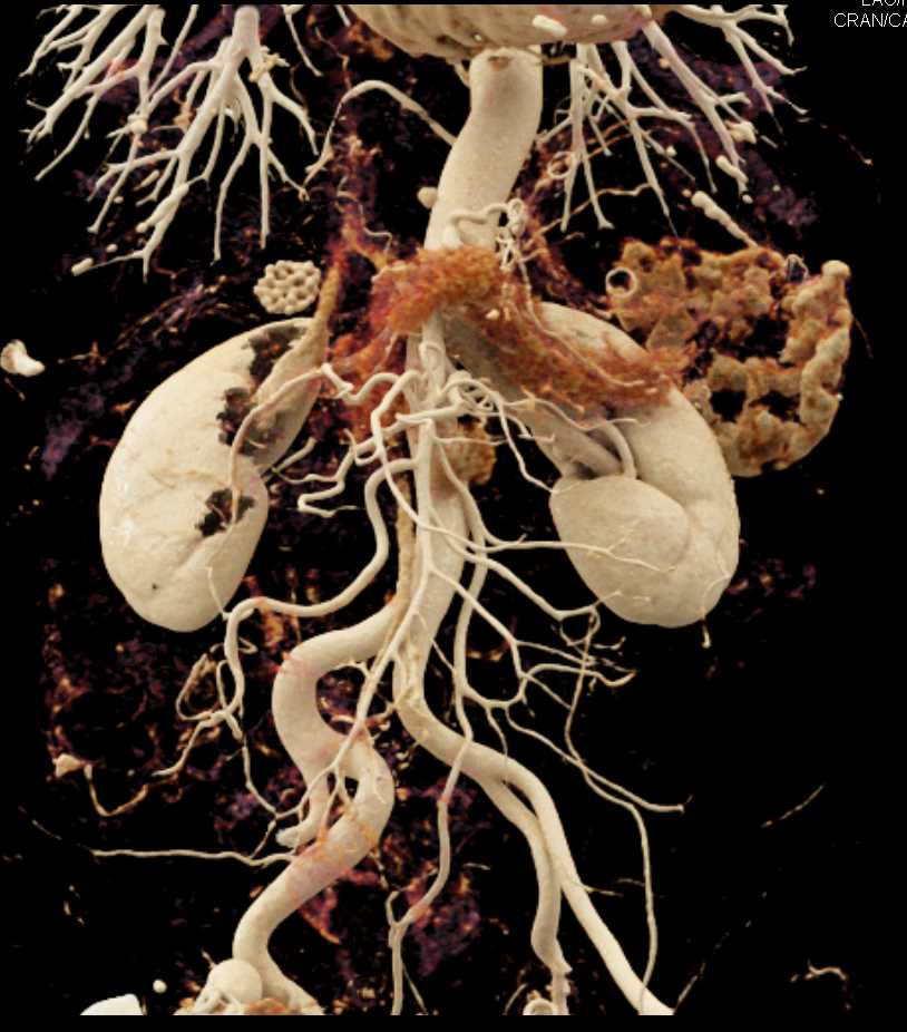 Coiling Of Pelvic Arteriovenous Malformation AVM In Right Pelvic Coiling Of Pelvic Arteriovenous Malformation AVM In Right Pelvic