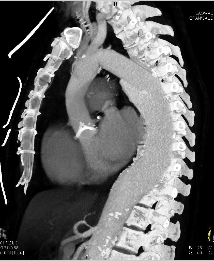 Aortic Valve Replacement AVR Repair And Repair Of The Ascending Aorta Aortic Valve Replacement AVR Repair And Repair Of The Ascending Aorta