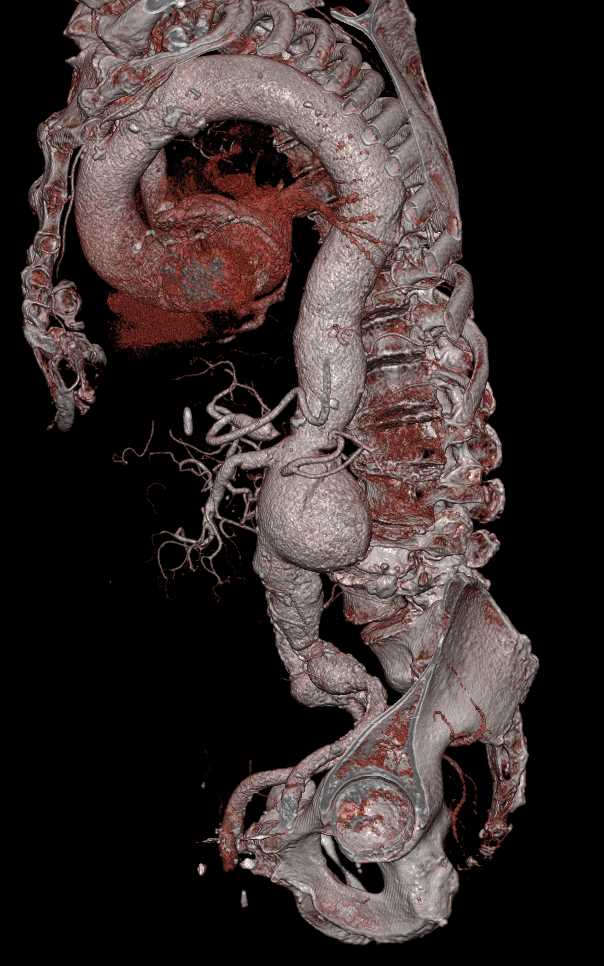 Abdominal Aortic Aneurysm Vascular Case Studies CTisus CT Scanning