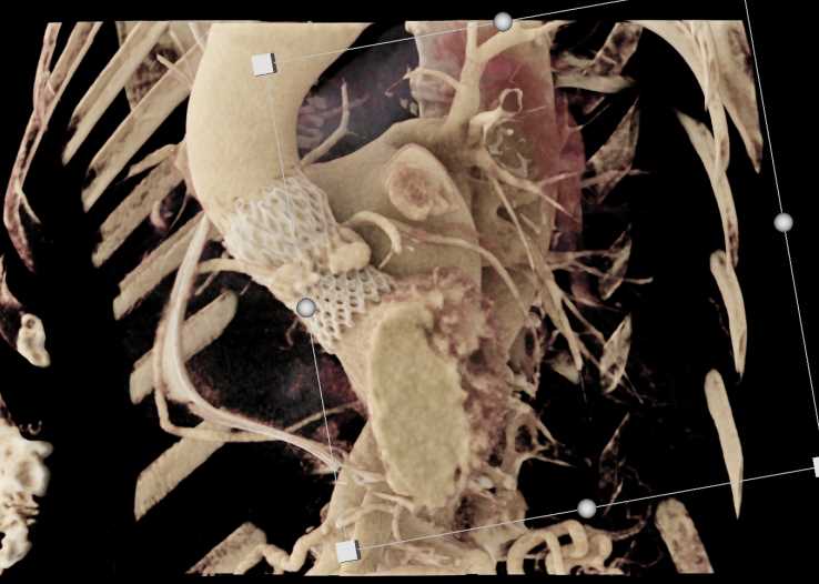 Post Transcatheter Aortic Valve Replacement TAVR Changes Aortic Valve Post Transcatheter Aortic Valve Replacement TAVR Changes Aortic Valve